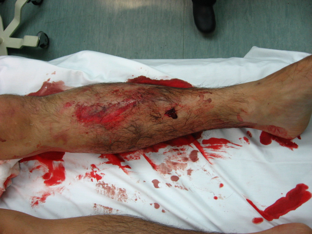 Montenbaik.com Martes de Medicina:: #3 Heridas